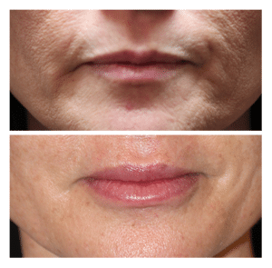 Facial Surgery Before & After Gallery Denver | Fante Eye & Face Centre