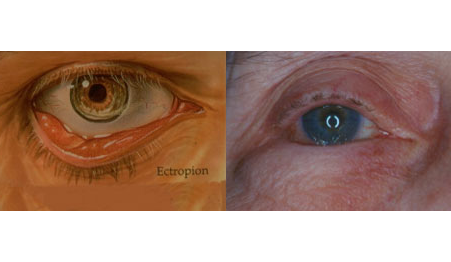 Eyelid Ectropion Surgery Denver | Eyelid Entropion Surgery Boulder