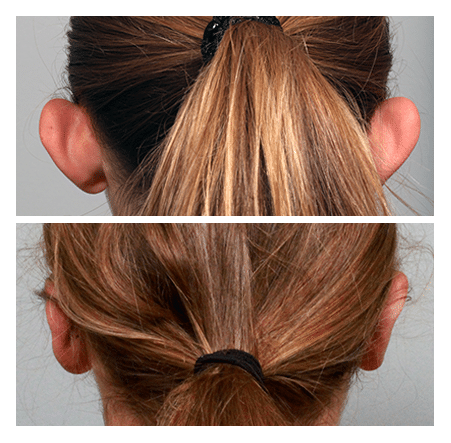 Facial Surgery Before & After Gallery Denver | Fante Eye & Face Centre