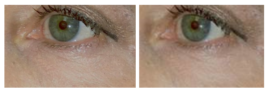 Accutite - Fante Eye and Face Centre