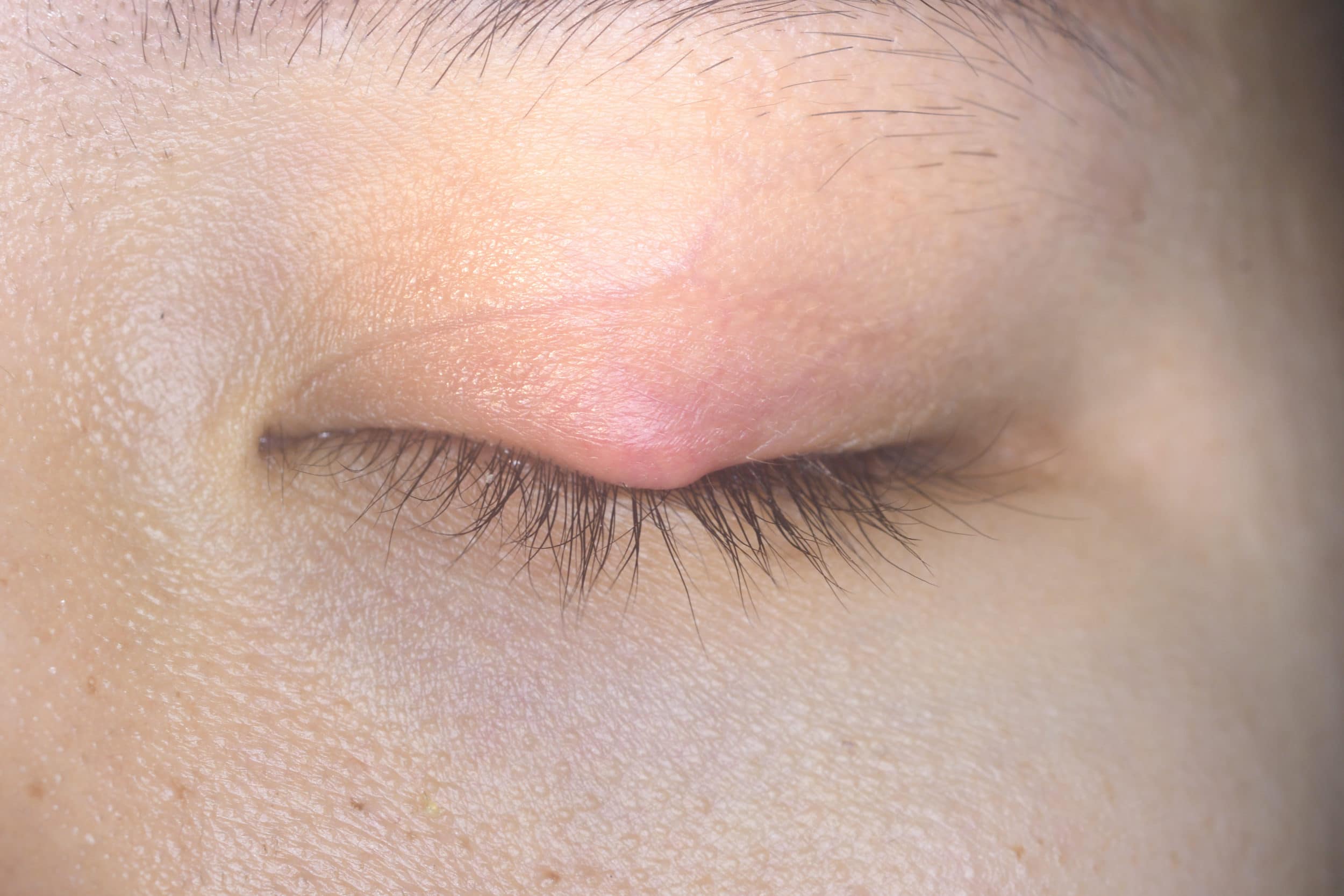 Eye Orbital Cellulitis