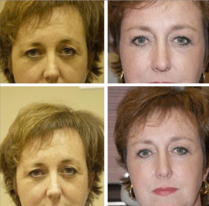 Brow Lift in Denver, CO | Fante Eye and Face Centre