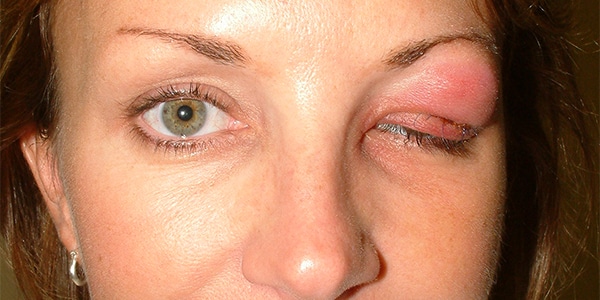 Lid Retraction - Fante Eye & Face Centre