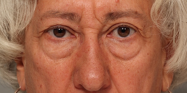Cosmetic Procedures Archives - Fante Eye & Face Centre