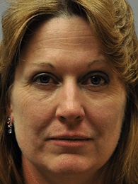 Gallery Cases Archive - Fante Eye & Face Centre