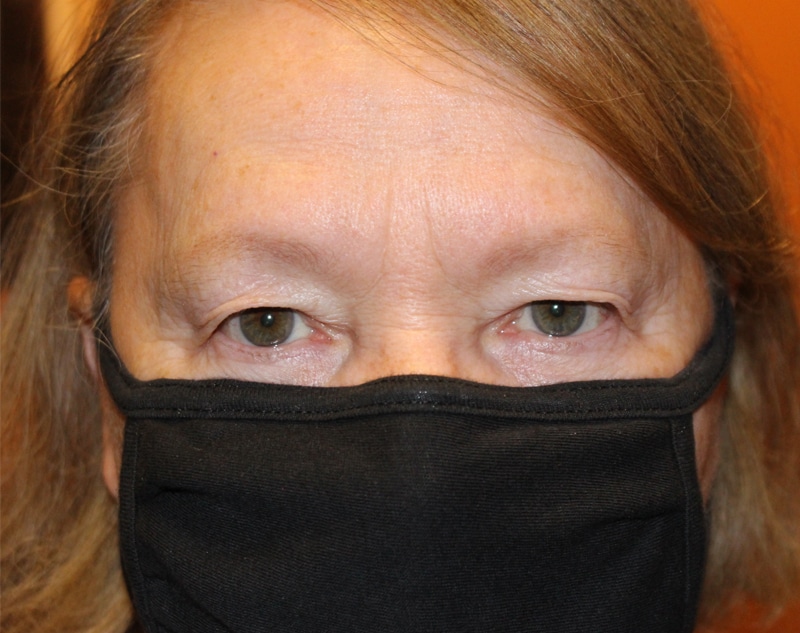 Reconstructive Procedures Archives - Fante Eye & Face Centre