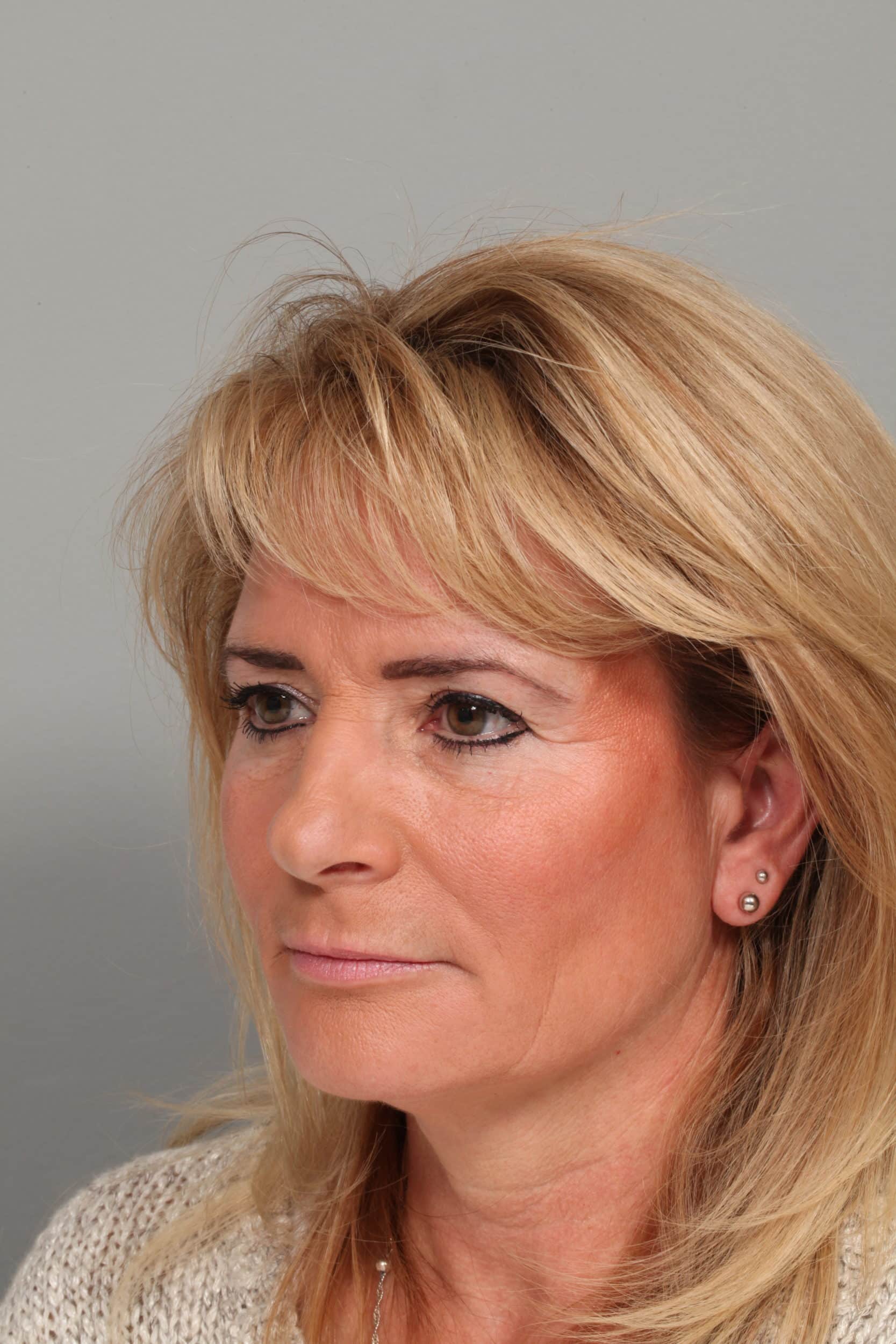 Gallery Cases Archive - Fante Eye & Face Centre