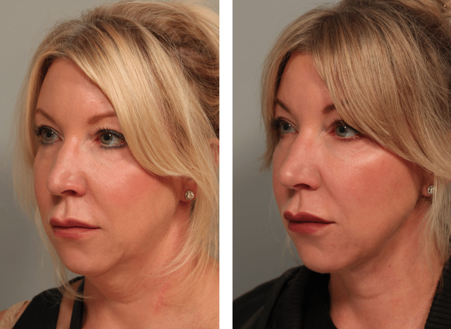FaceTite Denver CO - Face Tightening Treatment Aurora CO