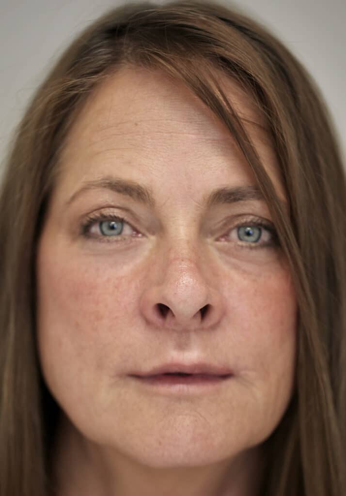 Cosmetic Lip Lift Denver CO - Lip Augmentation Aurora CO